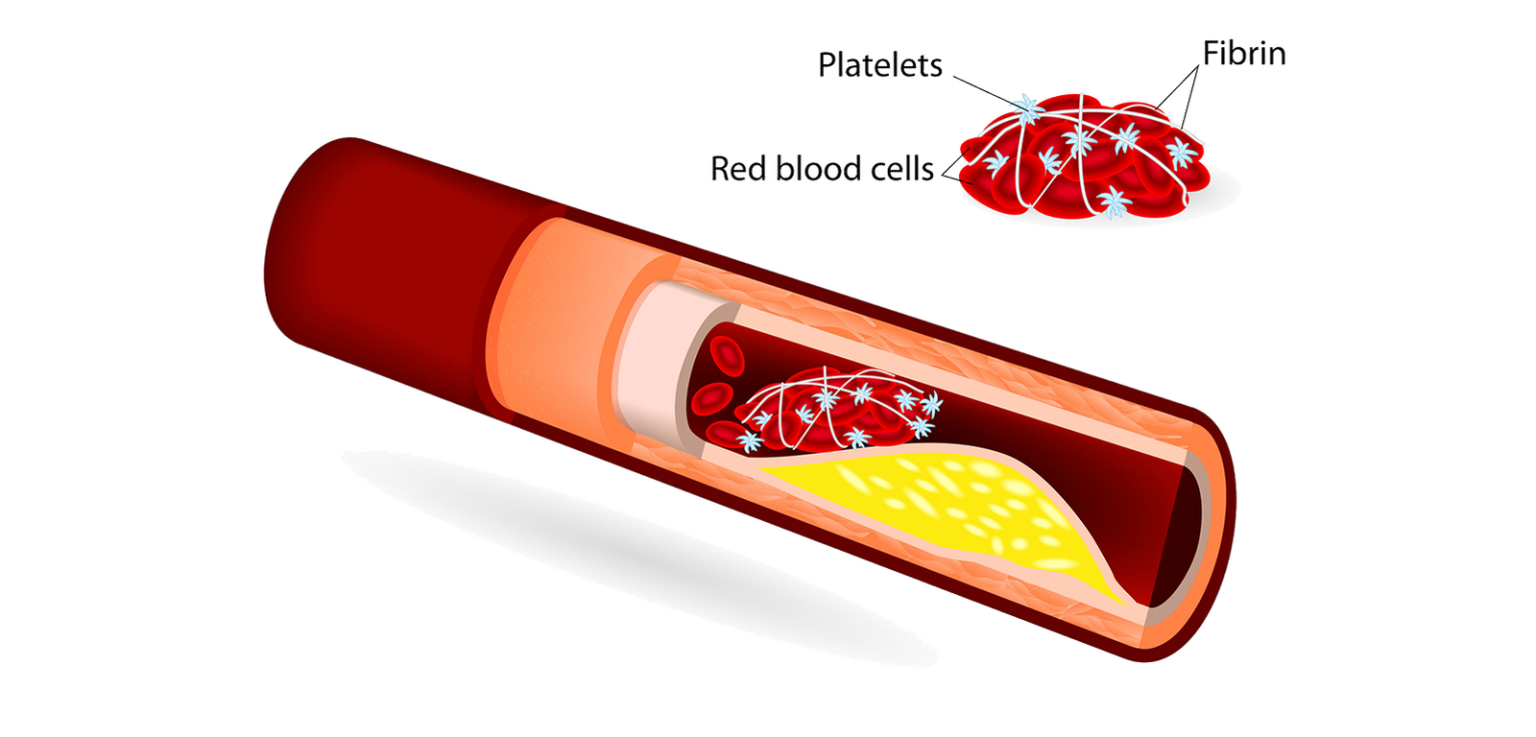 Blood Clots: Causes, Risks, and Prevention